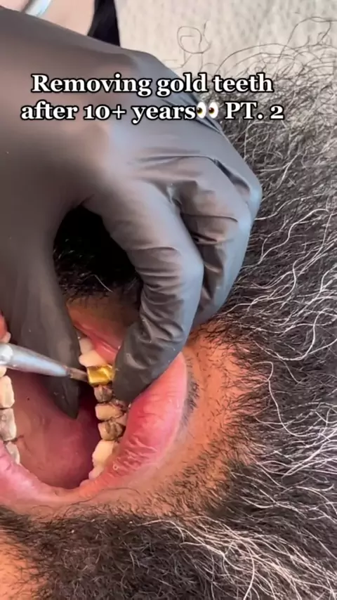 asmongold rotten teeth